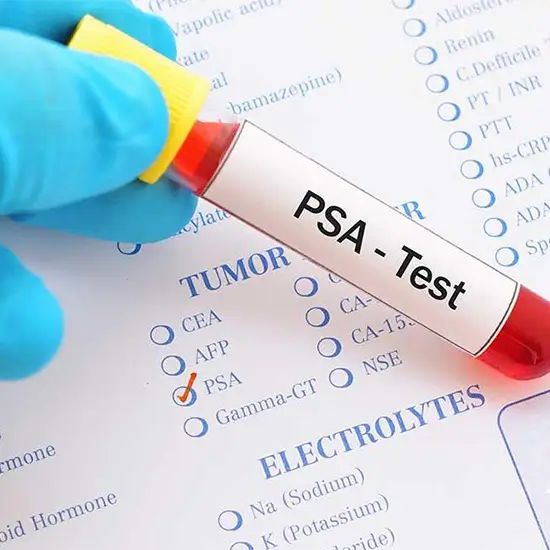 PSA Profile Test Near You In Delhi Book Test At Low Price